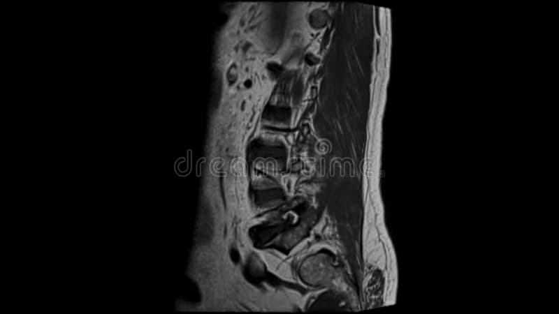 MRI of the Lower Back, Medical Analysis of the Back, Spine Stock ...