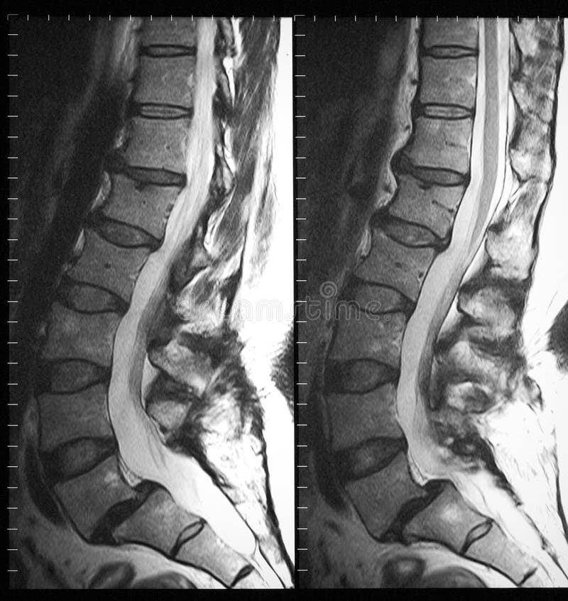 Mri Of Lumbar Spine In Sagittal Plane Royalty Free Stock Photos - Image ...