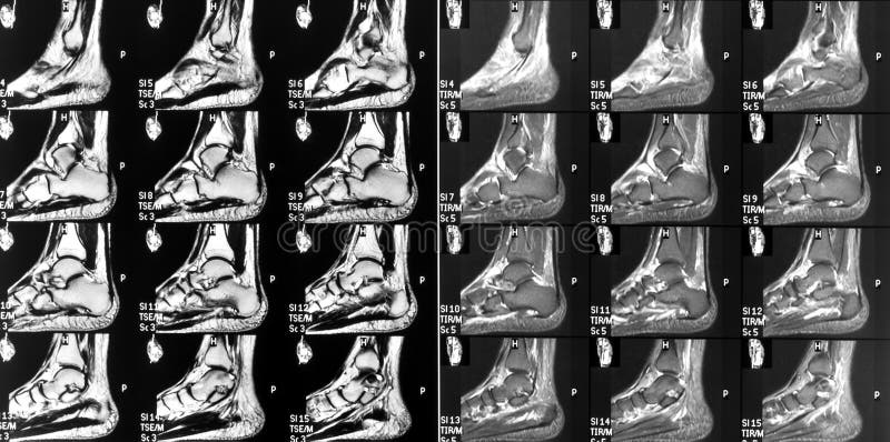 MRI Magnetic Resonance Scan Image of the Left Foot and Ankle Stock ...