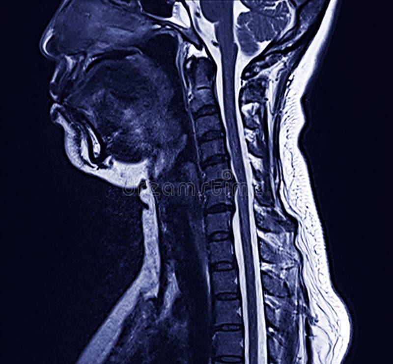 MRI neck stock photo. Image of disease, check, detail - 24527858