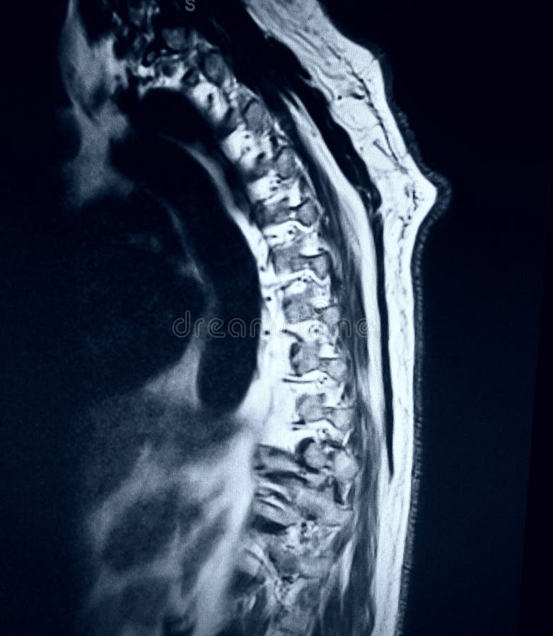 Mri Pathologique De Compression De Corps De Vertèbres Thoraciques Image ...