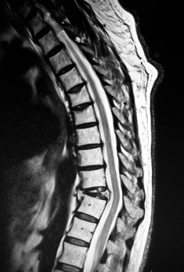 Mri Pathologique De Compression De Corps De Vertèbres Thoraciques Photo ...