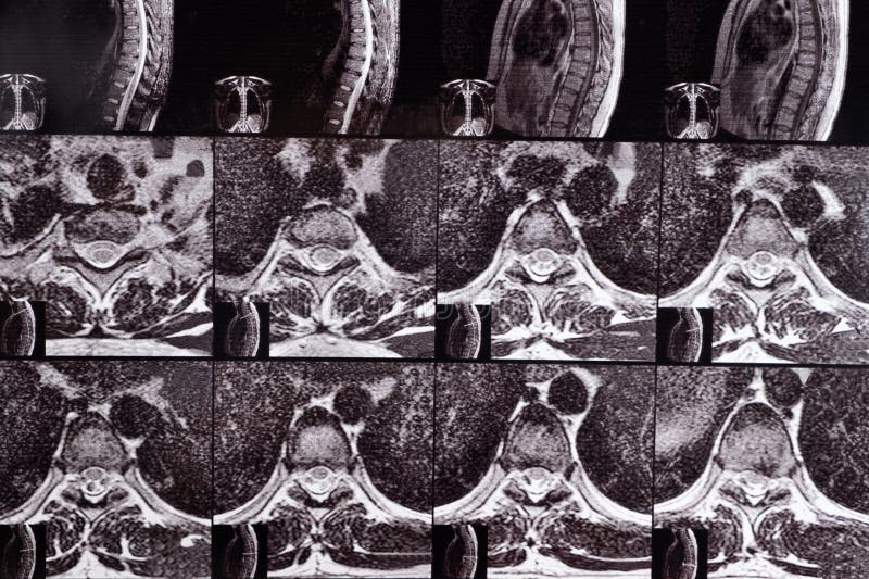 MRI of a Patient with Intervertebral Disc Protrusion and ...