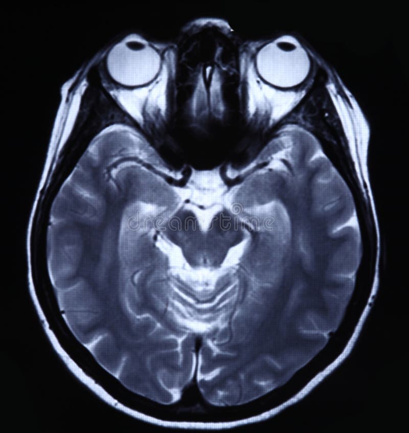 MRI of the brain stock image. Image of medical, resonance - 16741901