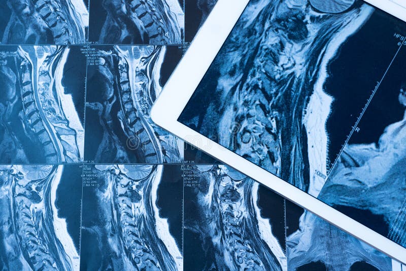 MRI Pictures of Spinal Column with Magnification on Overlaying T Stock ...