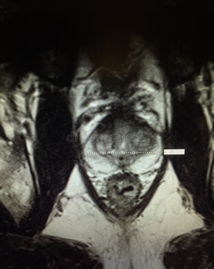 Mri Prostate Benign Hyperplasia Stock Photo - Image of growth, urine ...