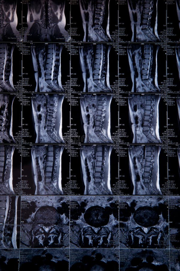MRI real scan stock image. Image of film, damage, scan - 25202121