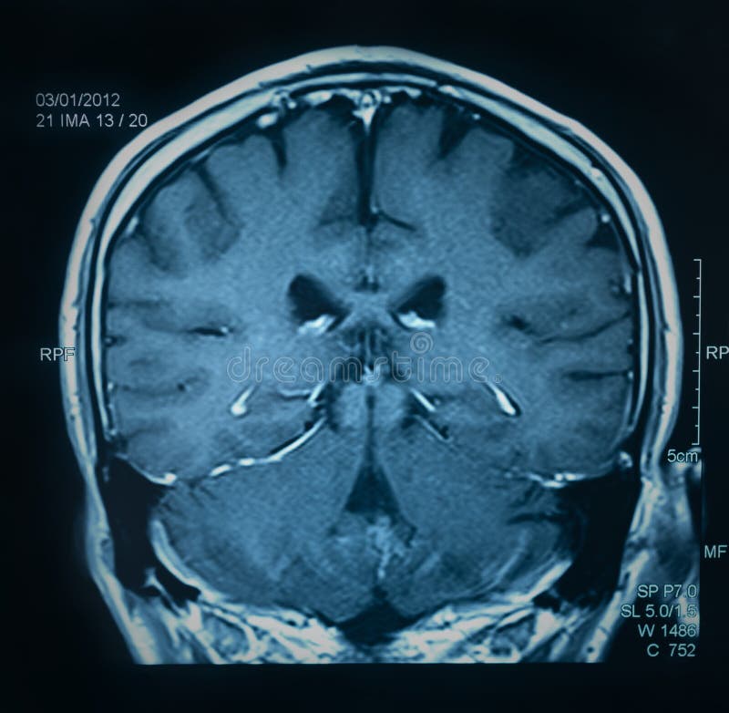 Mri scan brain stock image. Image of radiologist, film - 171944511