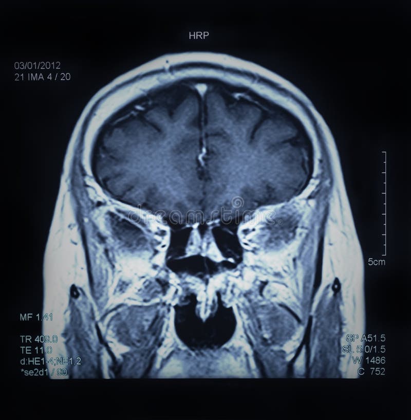 Brain cancer x-ray image stock photo. Image of disease - 184822440