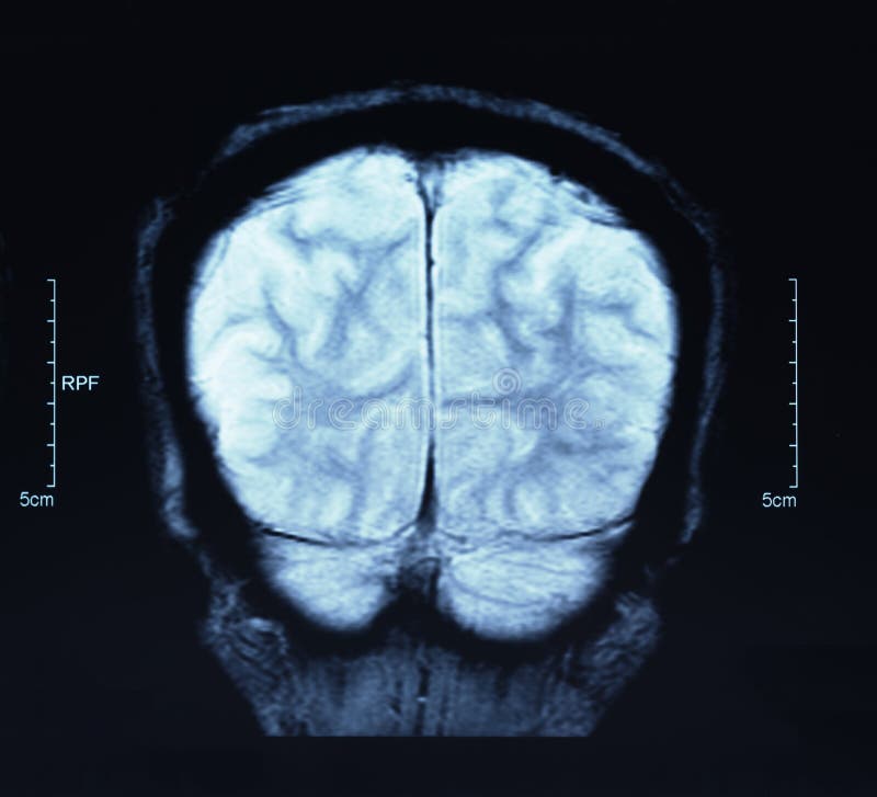 Mri scan brain stock image. Image of diagnostic, brain - 184822441