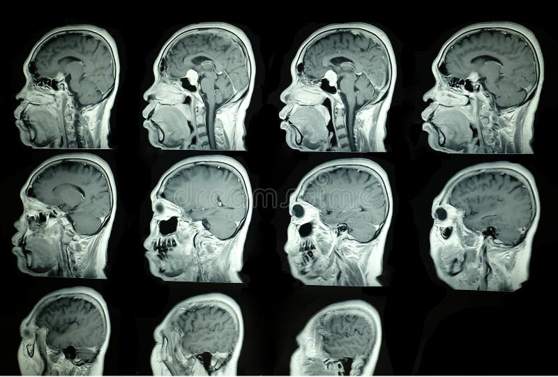 MRI scan of the brain stock image. Image of care, medicine - 106879139