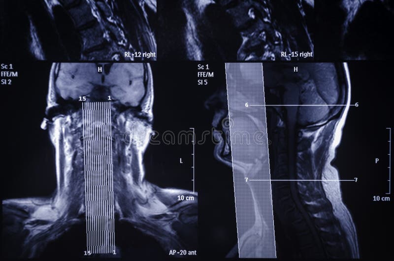 MRI scan stock image. Image of level, ischemia, body - 61970761