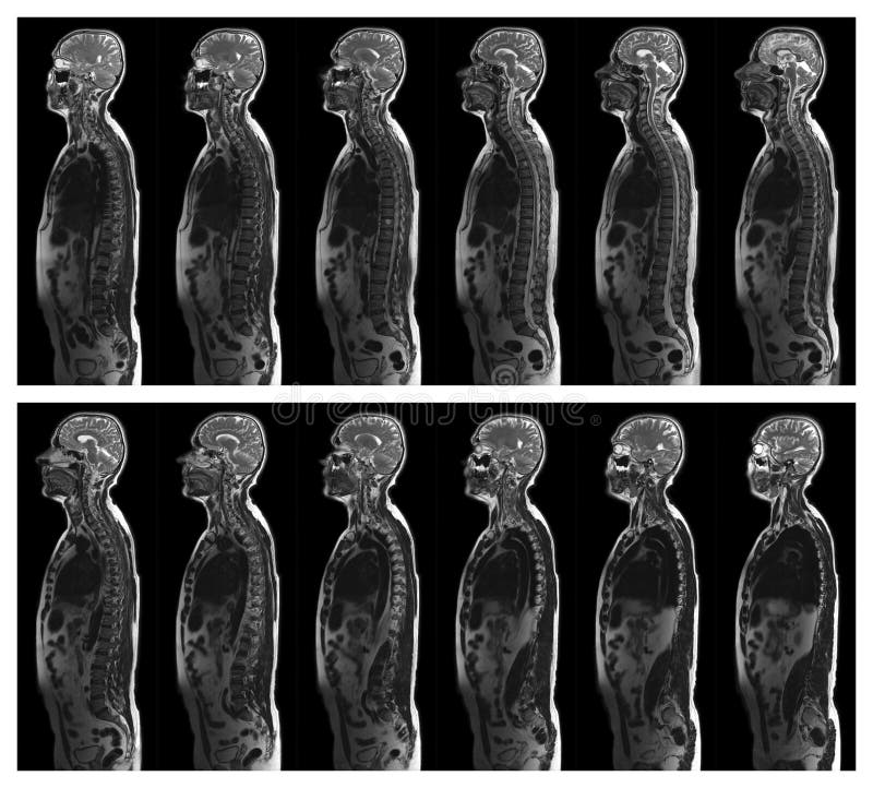 MRI scan stock photo. Image of disc, equina, ligament - 34800538