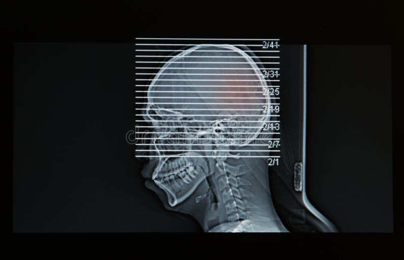 MRI Scan of Head of Human Show Head Injury Stock Image - Image of cross ...