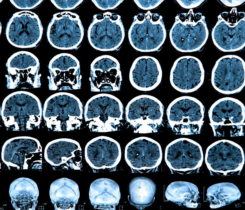 6,168 Mri Brain Scan Stock Photos - Free & Royalty-Free Stock Photos ...