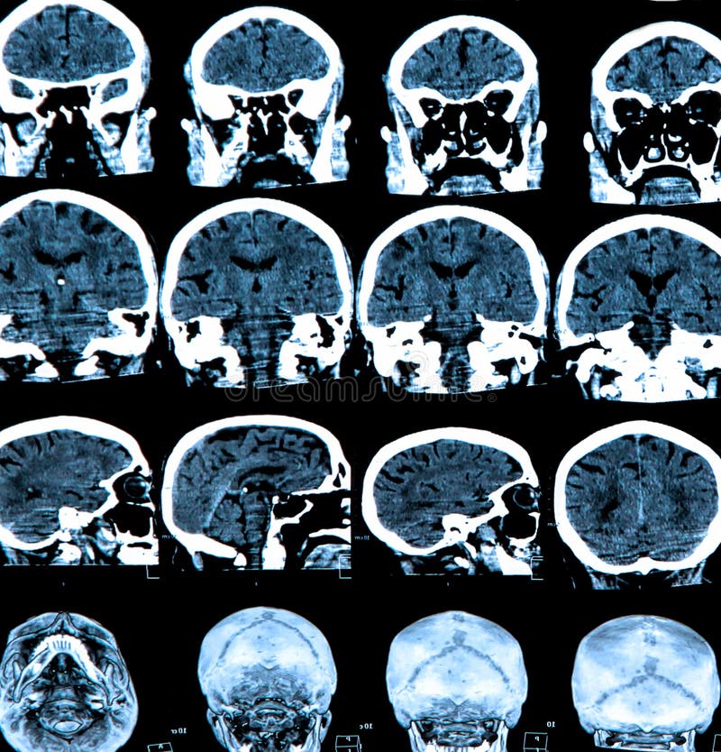 Mri Brain Scan stock photo. Image of frontal, neural - 48030916