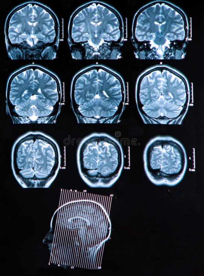 MRI Brain Scan stock image. Image of lateral, facial - 28673367