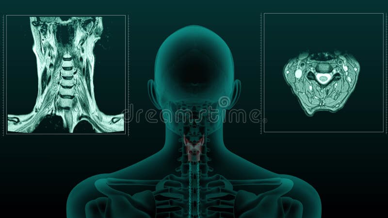 X-ray Scan of the Human Head and Neck with the Larynx Visible. 3d ...