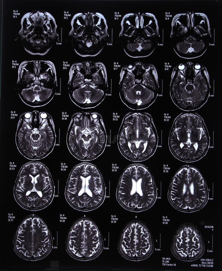 MRI scan image of brain stock photo. Image of human, diagnosis - 34023772