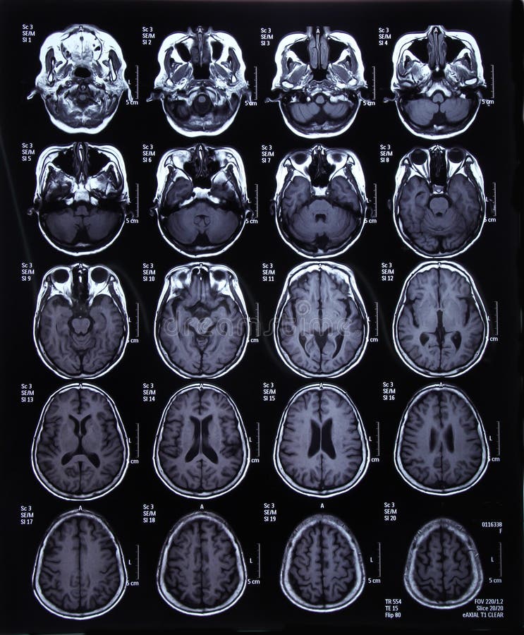 MRI scan image of brain stock image. Image of illness - 34023797