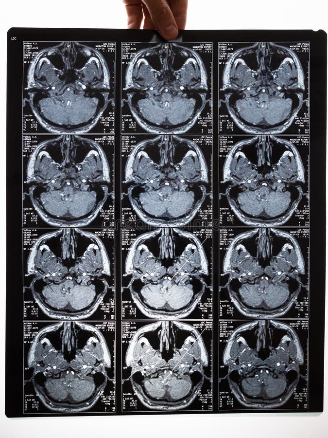 MRI Scan Image of Brain. Holds a Picture in His Hand Stock Image ...