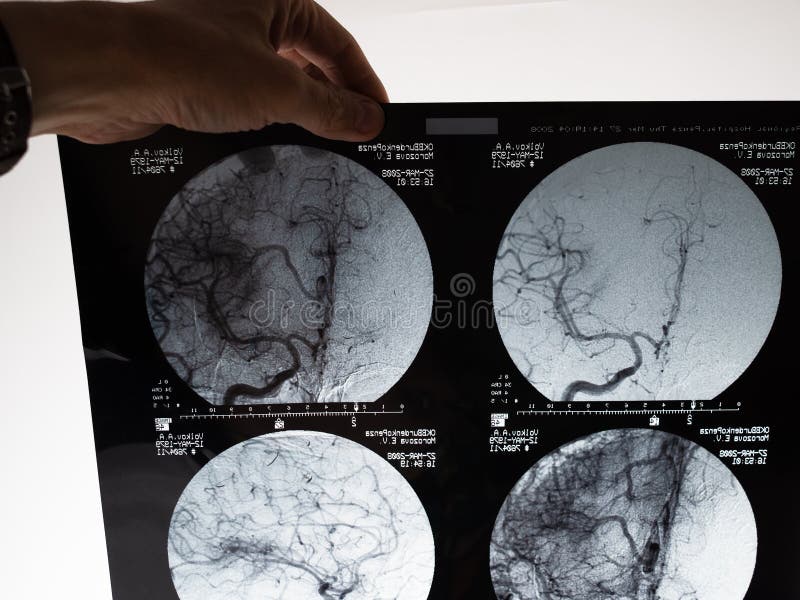 MRI Scan Image of Brain. Holds a Picture in His Hand Stock Photo ...