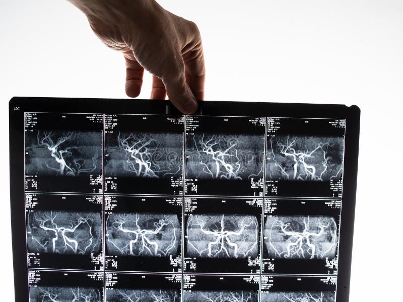MRI Scan Image of Brain. Holds a Picture in His Hand Stock Image ...