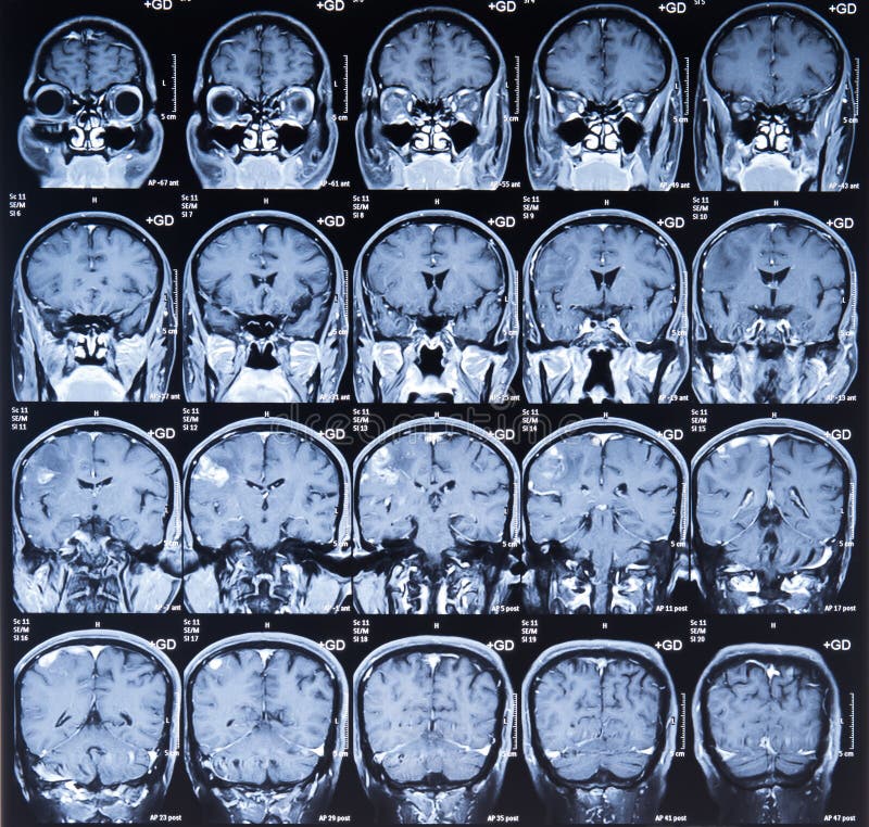 Mri scan image stock image. Image of magnetic, radiation - 47765033