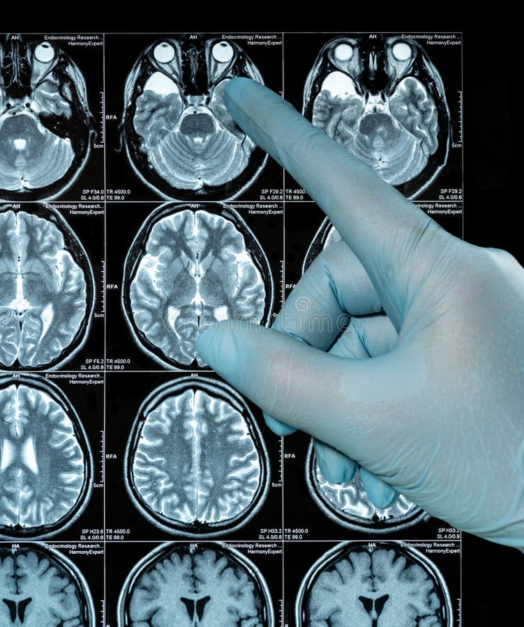 MRI Scan Image of a Human Brain Showing All Main Multiple Sclerosis ...