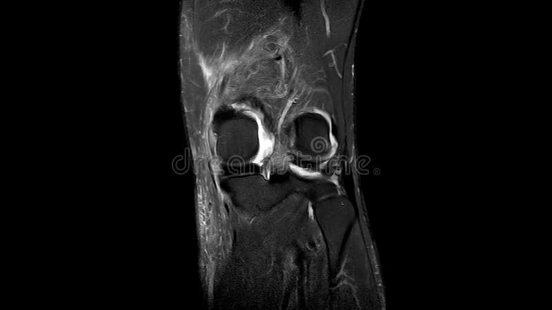 CT Scan Knee of the Patient Periarticular Injuries Fracture of the ...