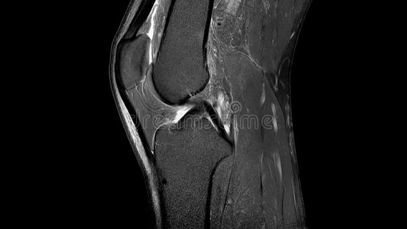 CT Scan Knee of the Patient Periarticular Injuries Fracture of the ...