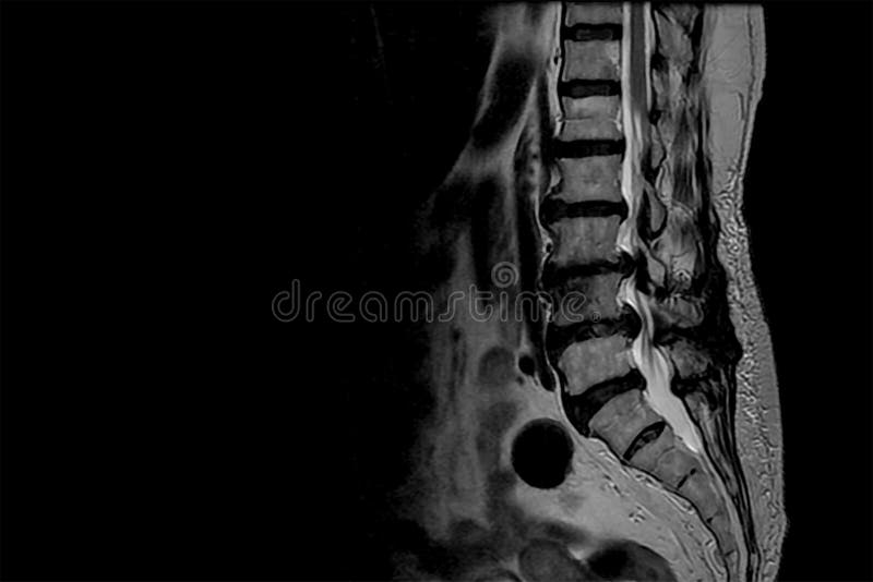 Sciatica Xray Stock Photos - Free & Royalty-Free Stock Photos from ...