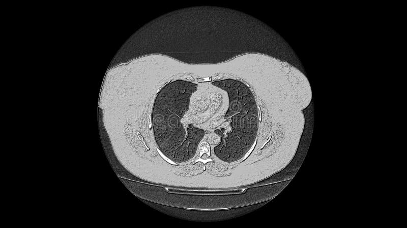MRI Scan of the Lungs and Bronchi, Diagnosis of Respiratory Diseases ...