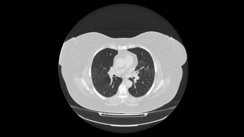 MRI Scan of the Lungs and Bronchi, Diagnosis of Respiratory Diseases ...