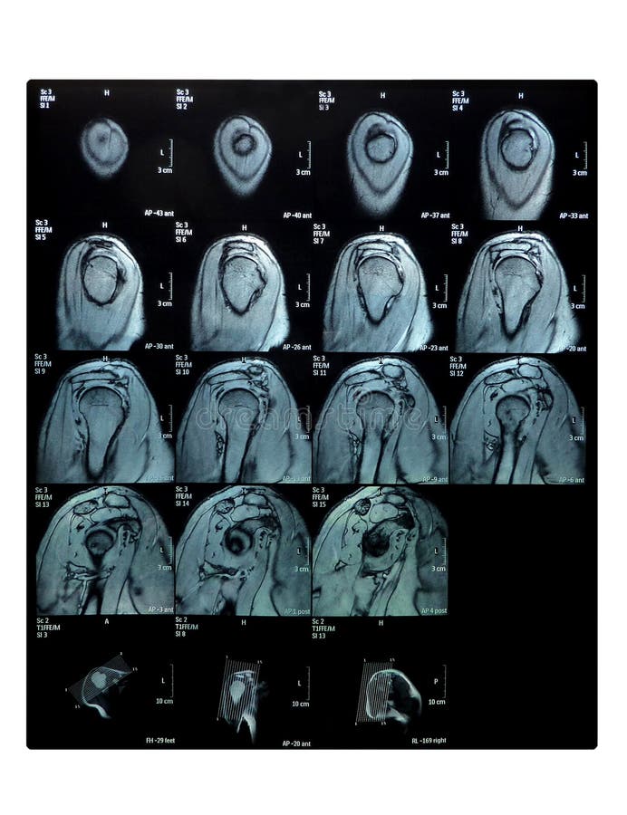 MRI Scan - Shoulder - Side View Stock Photo - Image of magnetic ...