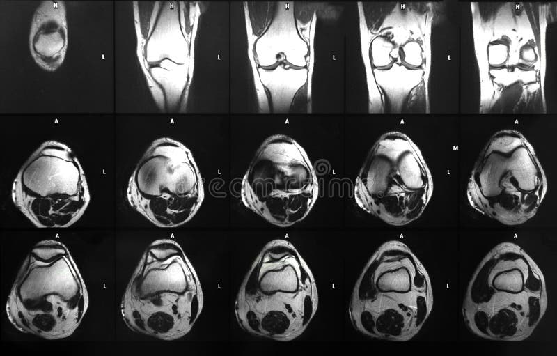 Mri Scans Knee Stock Photos - Free & Royalty-Free Stock Photos from ...