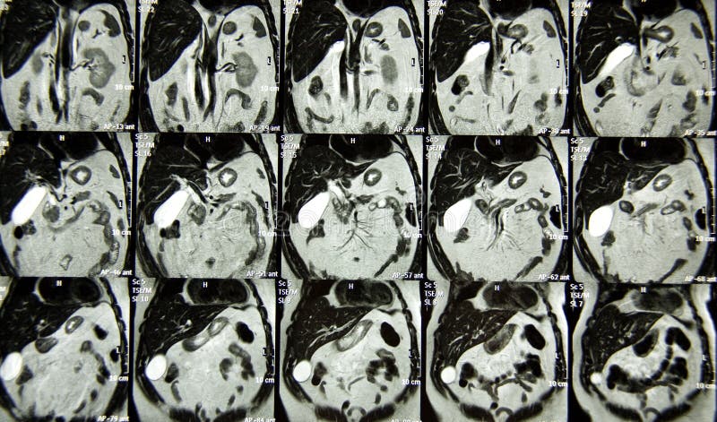 CT Van Buik, Lever, Milt, Nieren Stock Afbeelding - Image of berekend ...