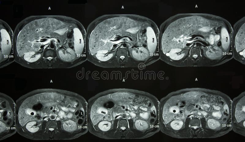 CT Van Buik, Lever, Milt, Nieren Stock Afbeelding - Image of berekend ...