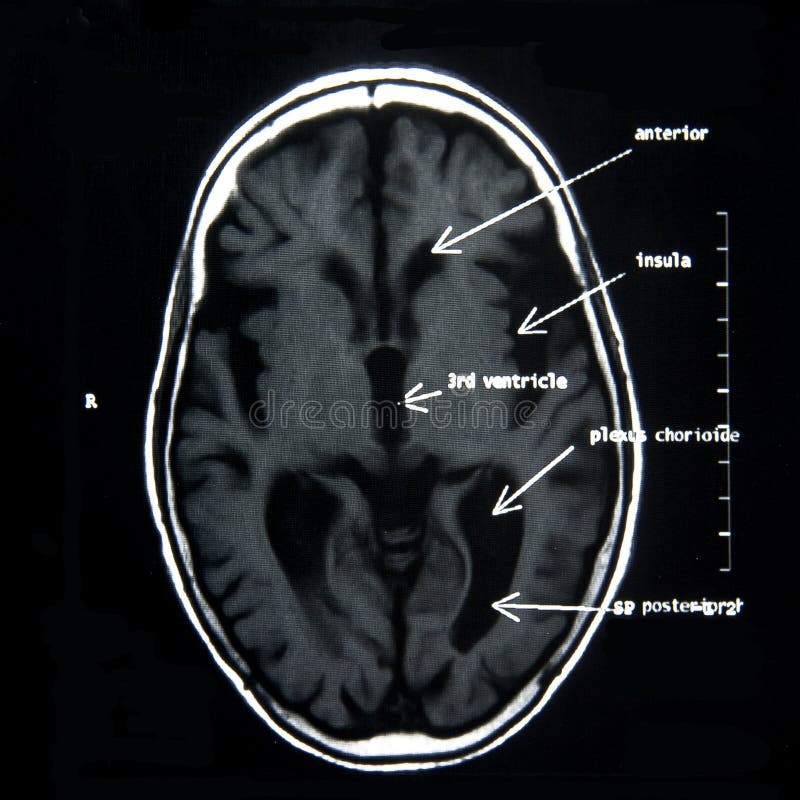 MRI van de hersenen stock foto. Afbeelding bestaande uit kliniek - 22068732