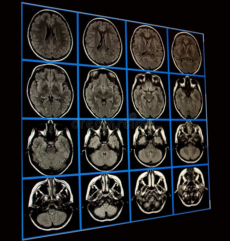MRI van hersenen stock foto. Image of encefalopathie - 22482386