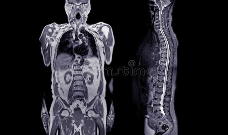MRI Whole Body Scans are Beneficial for Early Cancer Detection ... MRI Whole Body Scans are Beneficial for Early Cancer Detection ...