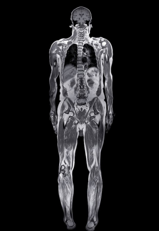 MRI Whole Body Scans are Beneficial for Early Cancer Detection ... MRI Whole Body Scans are Beneficial for Early Cancer Detection ...