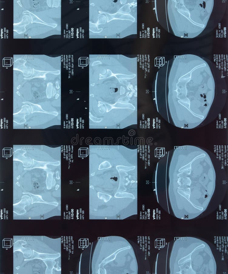 MRT-Sacroiliac-Artikulation. Studie Zur Morbus Bechterew Stockbild ...