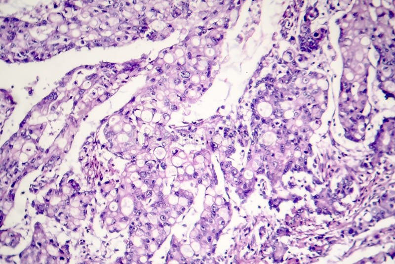 Mucinous Carcinoma of the Stomach Stock Image - Image of pathology ...