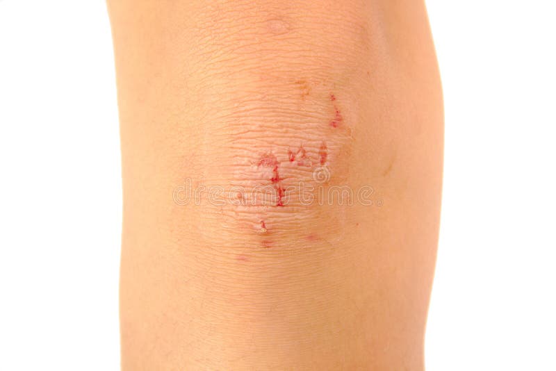 Herida Del Rasgu?o En El Primer Femenino De La Rodilla, La Atenci?n ...