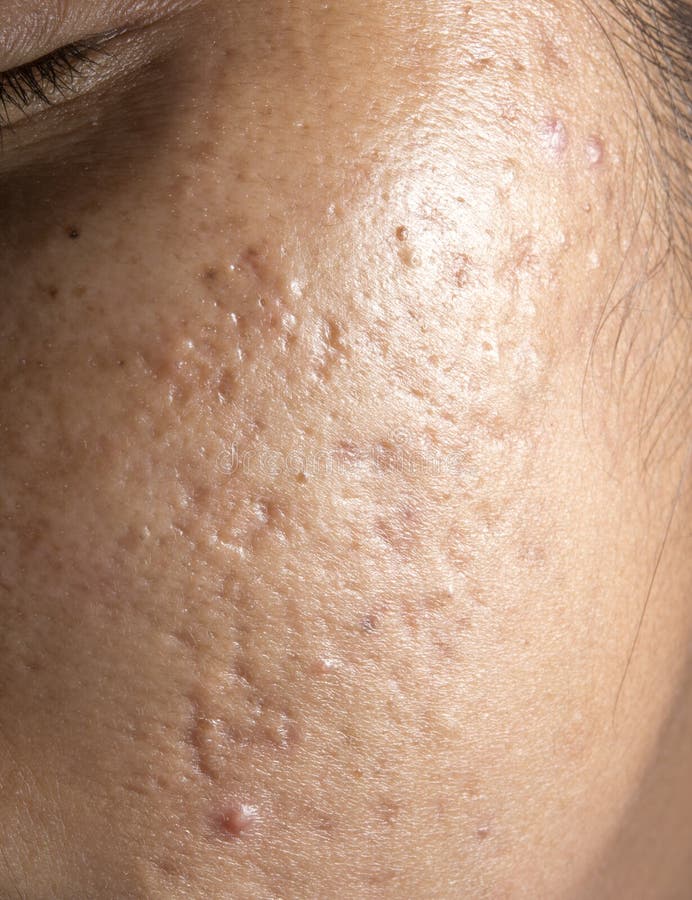 Close Up Para A Acne No Queixo Foto de Stock - Imagem de saudável, novo ...