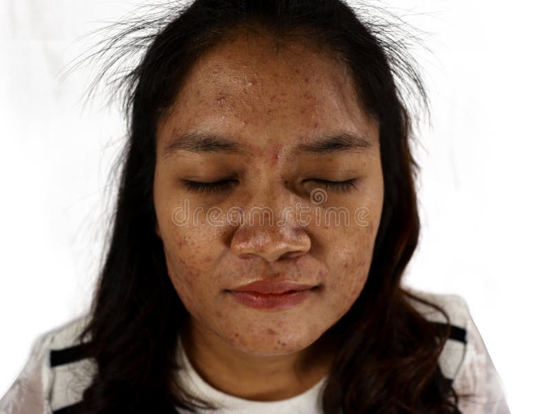 Mulheres De Pele Grossa Com Acne Imagem de Stock - Imagem de glândula ...