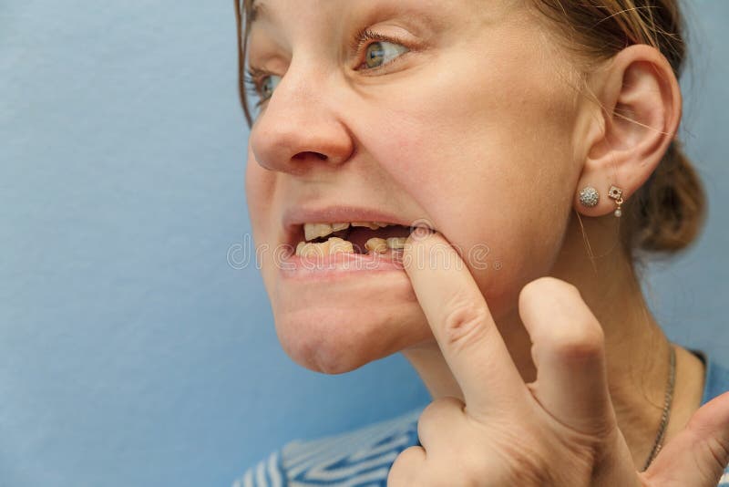Mulheres Sem Dente Quebrado Imagem de Stock - Imagem de medicina ...