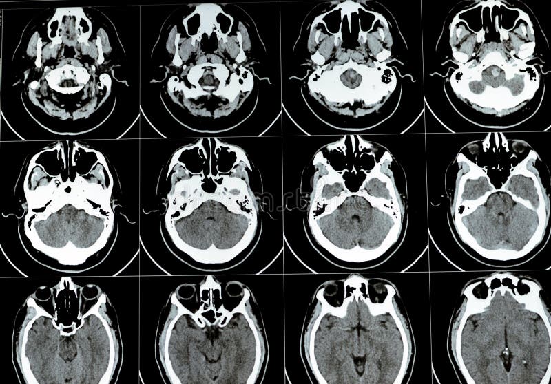 Multi Slice CT Scan of the Brain Showing Large Brain Stem and Right ...