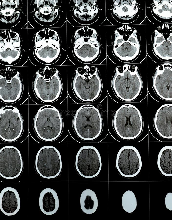 Multi Slice Ct Scan Of The Brain Showing Large Brain Stem And Right Centrum Semiovale Hematoma